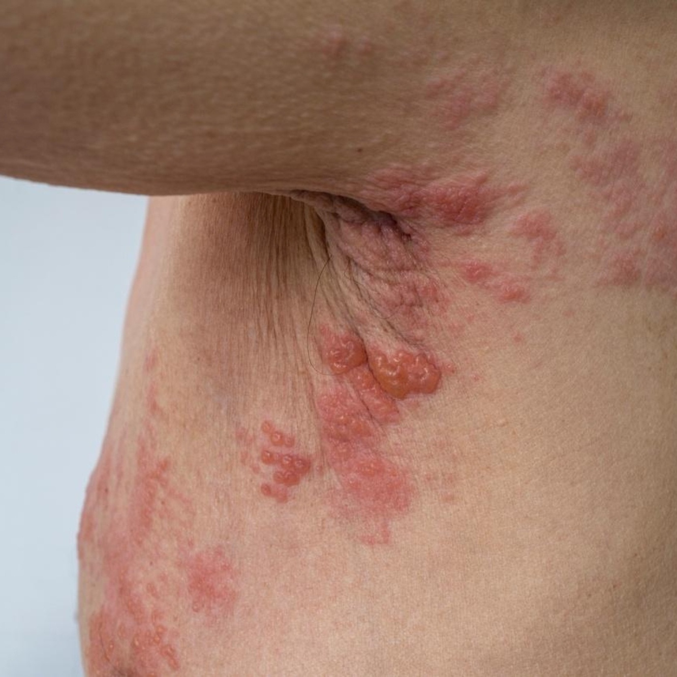 Erupcao Cutanea Com Varicela Apos Vacina