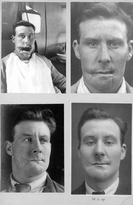 Fotos: Conheça imagens raras do 'pai da cirurgia plástica facial' - 18 ...