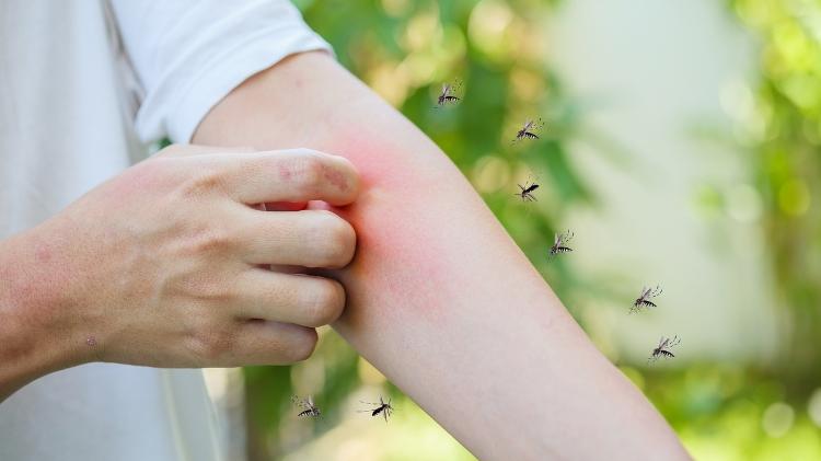 Braços e pernas inchados: como saber se é alérgico a picadas e o que ...