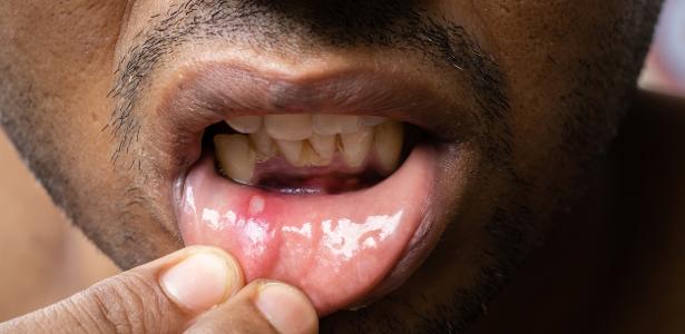 Remédio Para Afta: O Que É Bom Tomar? (Caseiros e À Venda)