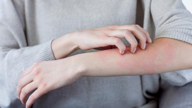 Dengue: veja sintomas que você deve conhecer e quando ir ao médico - 30 ...