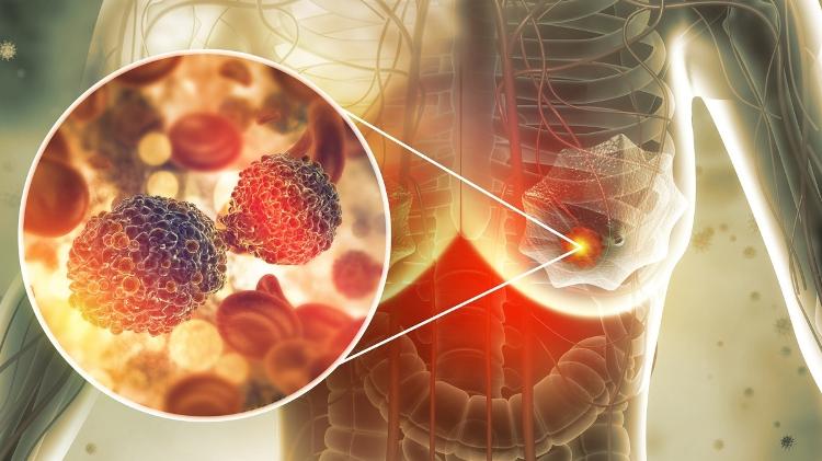 Após parto, ela quebrou a perna e descobriu que era um câncer ...