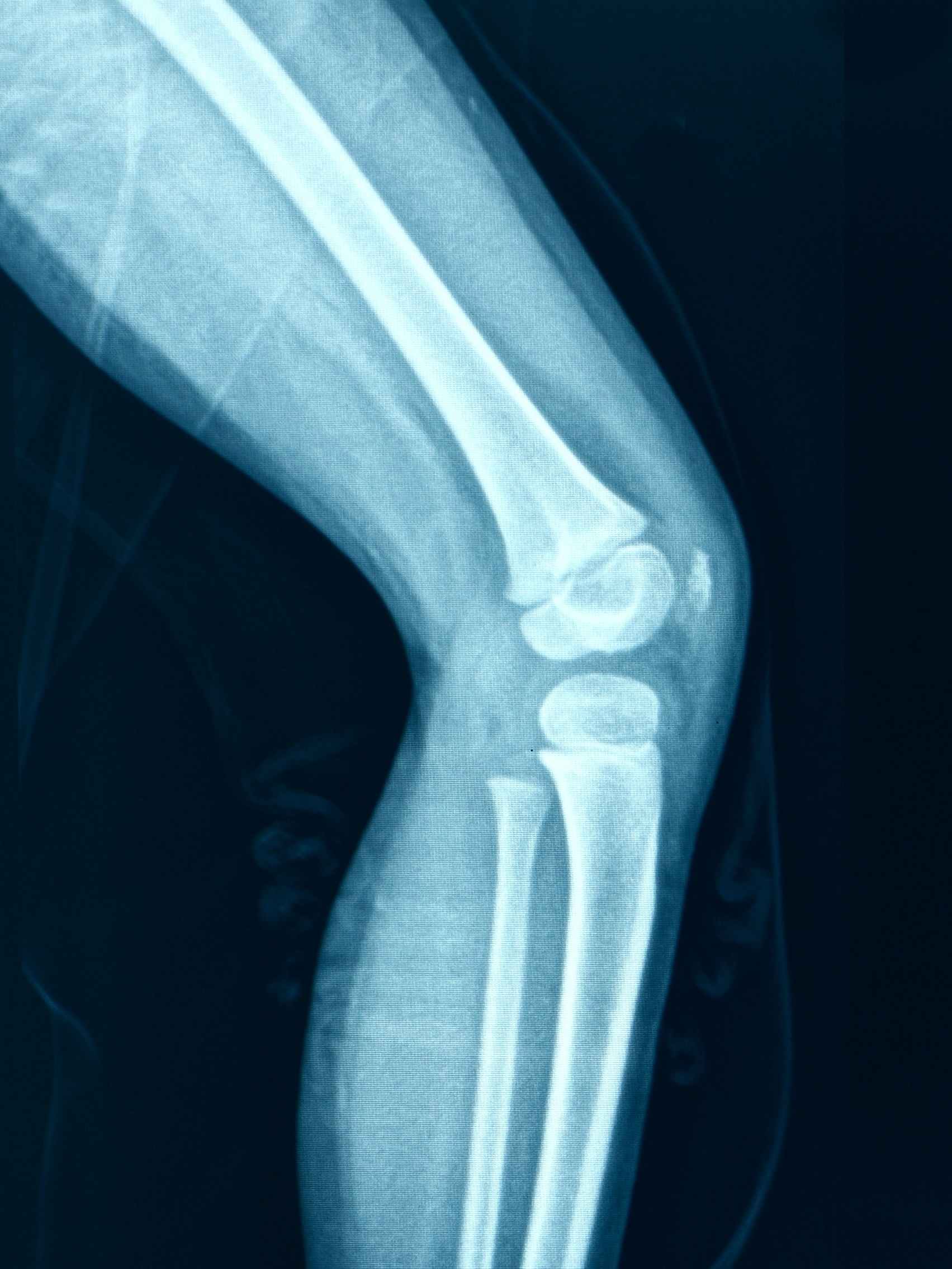 Ossos Da Perna De Raio X Imagem Chocante Mostra Raio X De Joelho Do