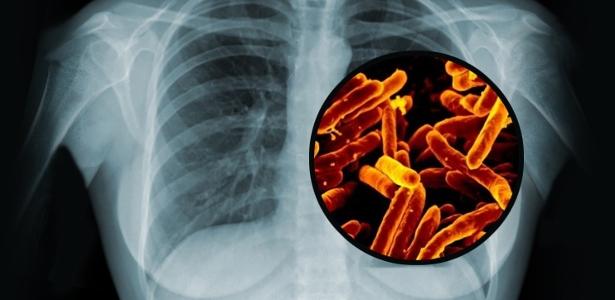 Novas moléculas inibem enzima importante para a bactéria da tuberculose - 21/08/2020 - UOL VivaBem