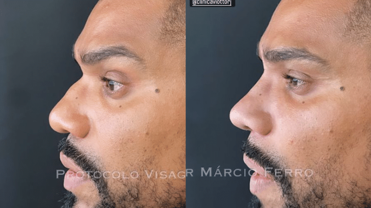 A Fazenda 2022: Naldo faz transformação no nariz; veja antes e depois