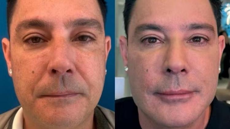 Vavá faz transplante capilar após harmonização facial