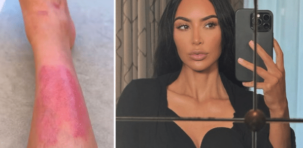 Kim Kardashian présente des lésions de psoriasis ; qu'est-ce que c'est ...