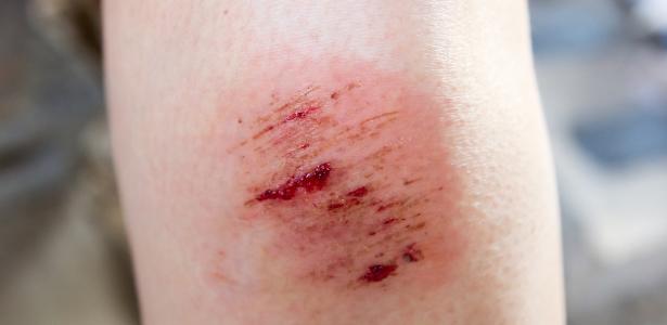 Ferida que sangra e não cicatriza pode sinalizar um câncer de pele