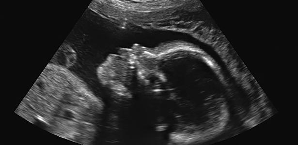 Morte de feto fez governo ligar microcefalia a febre oropouche