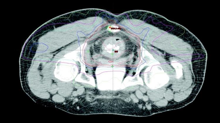Câncer de reto: chance de recorrência é menor após 3 anos sem tumores ...
