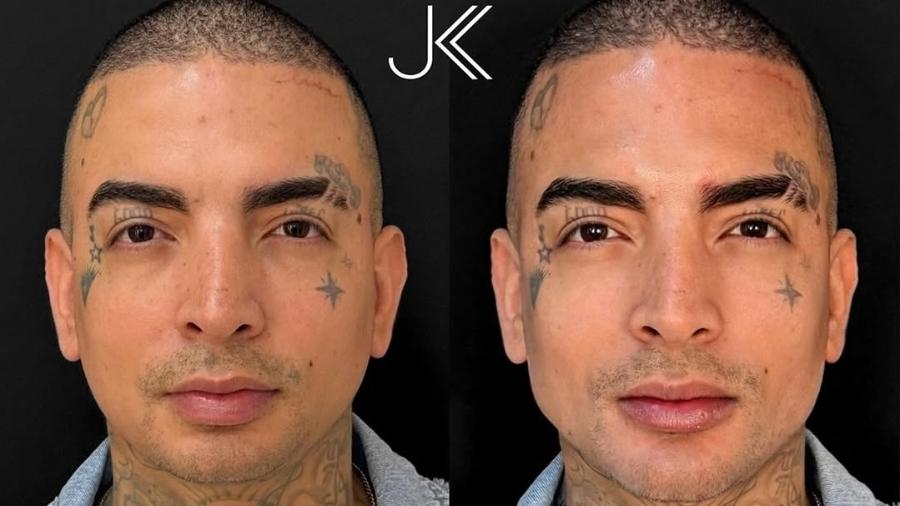 MC Guime compartilha resultado de procedimento estético; veja