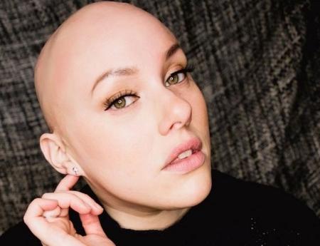 Alopecia: 'Decidi que não podia mais esconder quem eu era de verdade ...