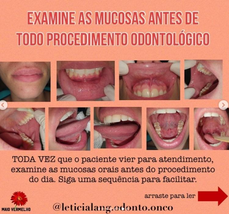 Câncer de boca: O que é? Quais sintomas e tratamento?