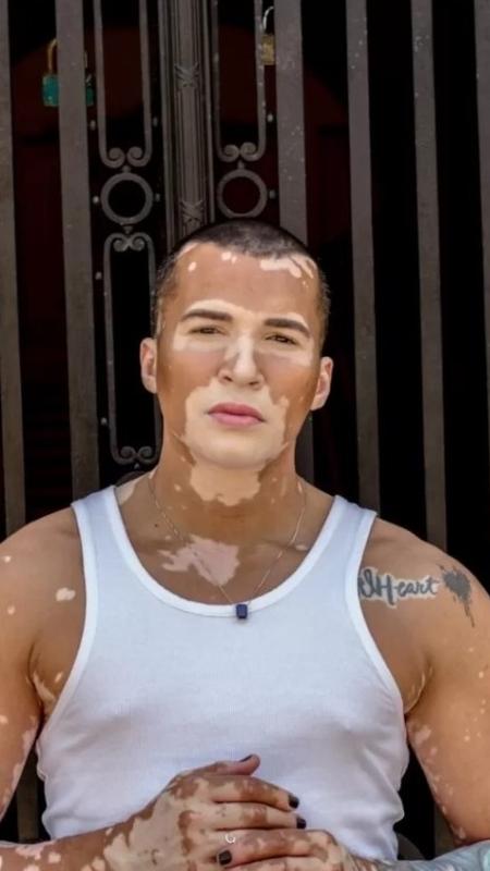 BBB22: pessoas com vitiligo dizem que presença de Natália ajudou a ...