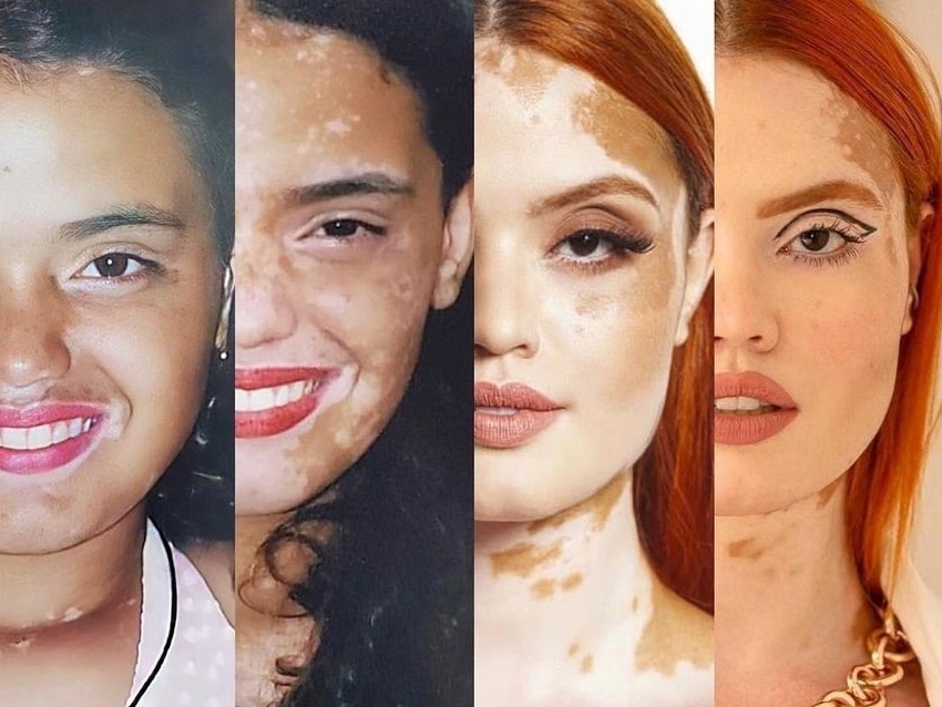 Vitiligo Antes E Depois