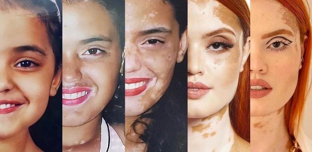 'Acham que acelerei clareamento, mas tenho tipo raro de vitiligo'
