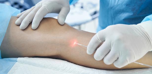 Endolaser: como funciona procedimento que fotógrafa que morreu ia fazer ...