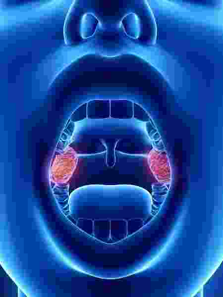 Amígdalas protegem organismo de infecções e retirada deve ser ...