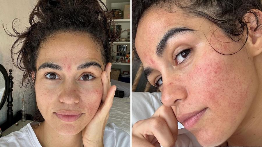 Nanda Costa exibe rosto e fala que está sentindo colágeno se esvaindo