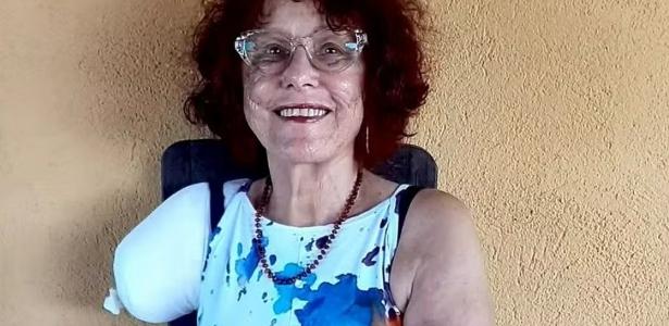 Roseana Murray exibe orelha implantada após ataque de pitbulls ...