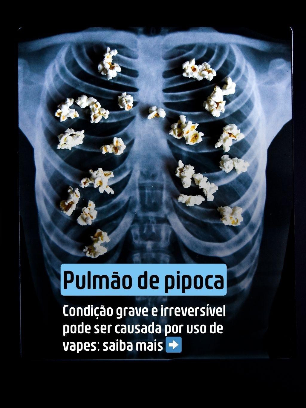 Pulmão de pipoca: condição grave e irreversível pode ser causada por ...