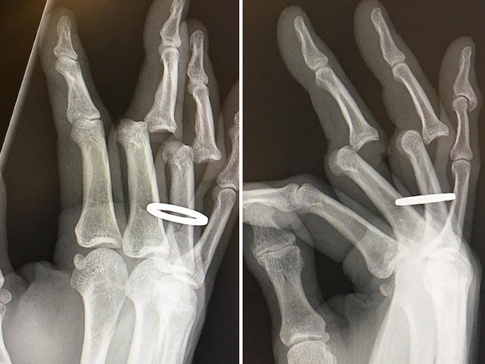 Imagem Raio Mostrando Deslocamento Dedo Isolado Fundo Preto — Foto ...