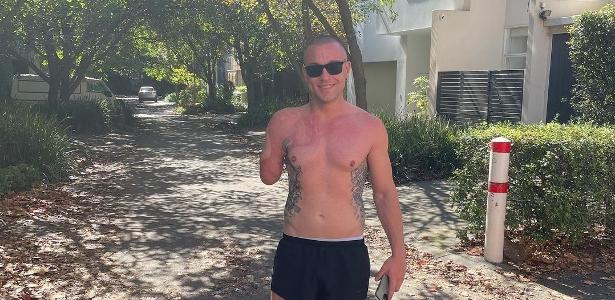 Atleta tem braço amputado após sofrer com bactéria devoradora de carne