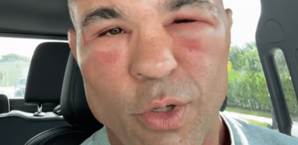 Belfort fica com rosto inchado após implante capilar: Pareço o Balboa