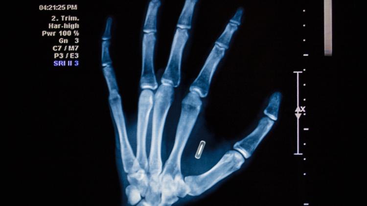 Como funcionam os microchips implantados sob a pele que permitem pagar ...