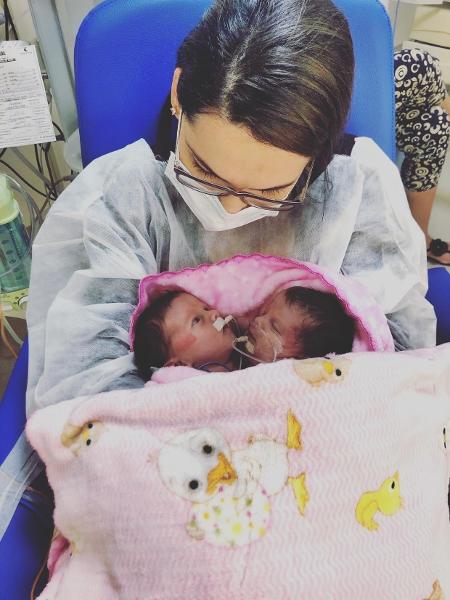 Siamesa nascida unida à irmã pelo tórax deixa hospital pela 1ª vez