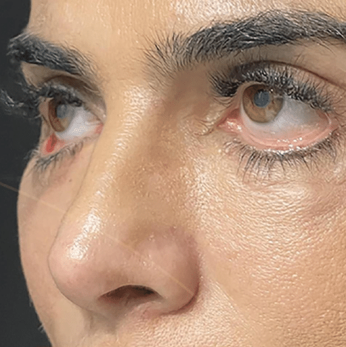 Infeccao Ocular Palpebra Inferior Plástica Ocular Paulista