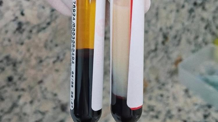 Amostra de sangue branco por colesterol alto viraliza: mas é possível?