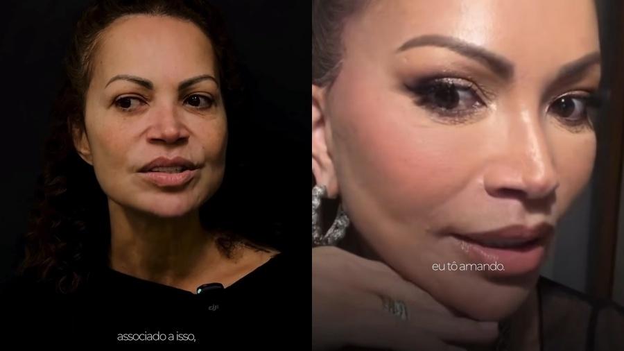 Solange Almeida exibe antes e depois de lifting facial nas redes