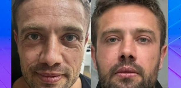 Rafael Cardoso surpreende ao mostrar resultado de harmonização facial