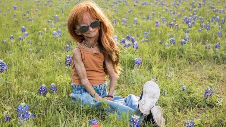 Adalia Rose: quem é a youtuber com doença rara que morreu aos 15 anos