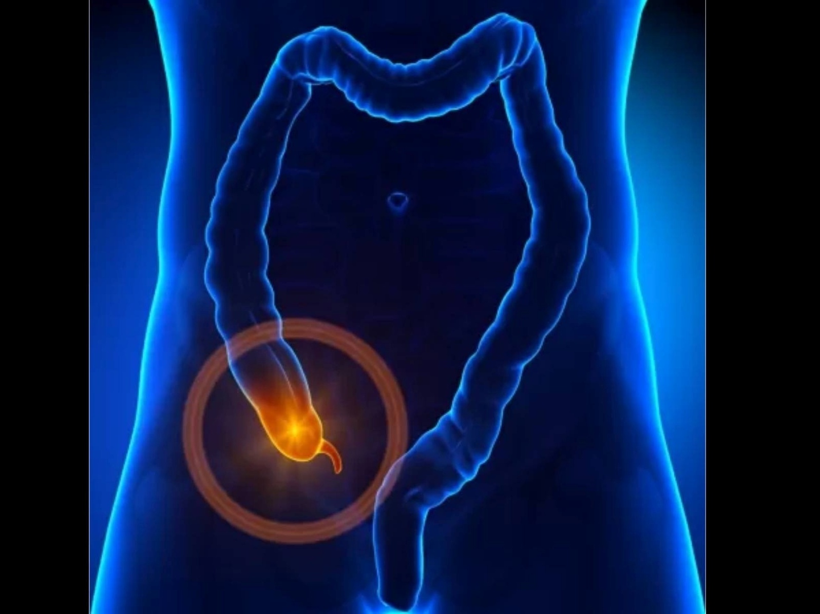Apendicite: quais são as causas, como tratar e identificar a doença ...
